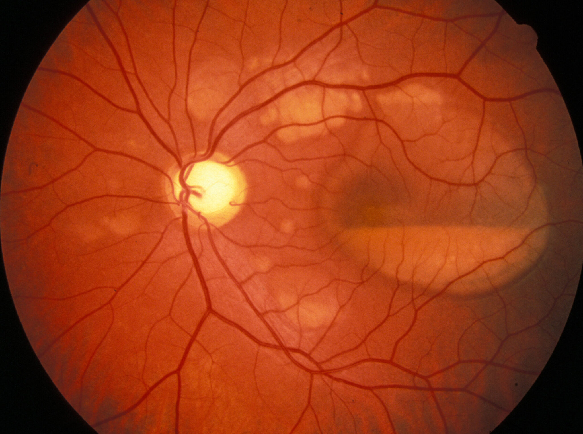Disorders of Retina & Vitreous - St John of God Eye Clinic